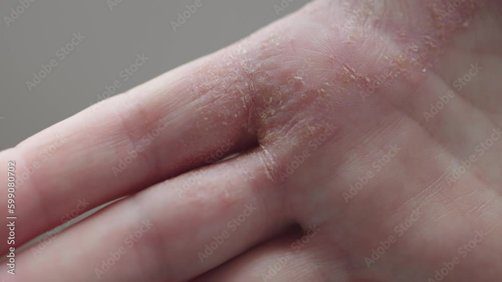 atopic dermatitis on hands dry itchy inflamed skin flare irritations on palm of hand. dry cracks ...