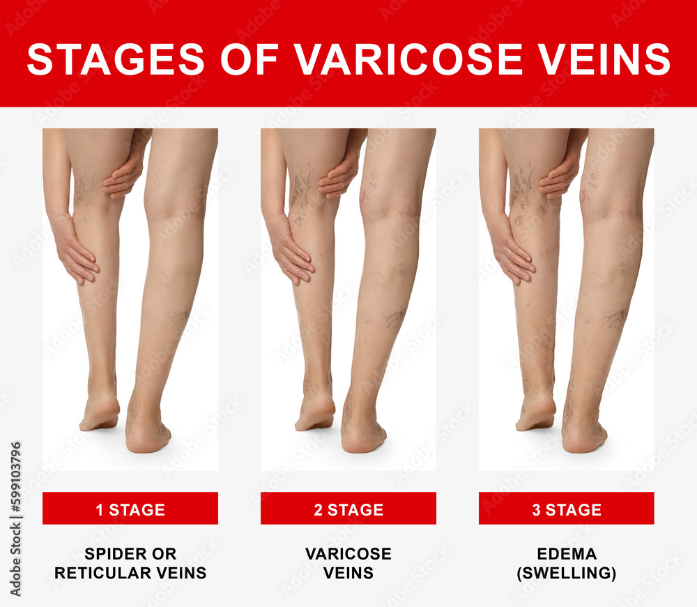 Stages of varicose veins. Collage with photos of woman showing changes ...
