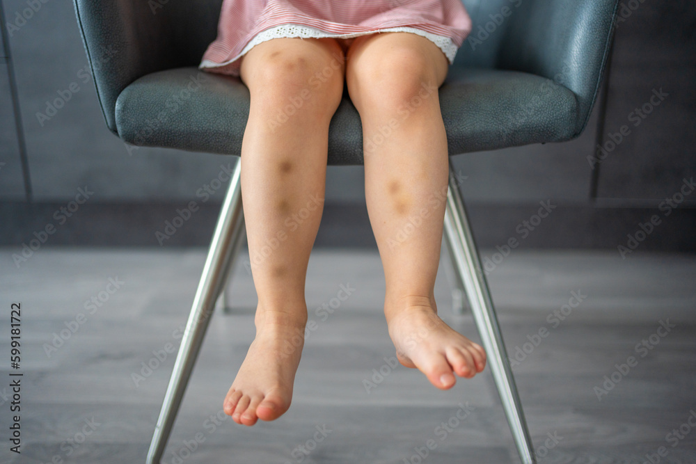 Close up of stains bruise wound on legs of little girl. Extravasation ...