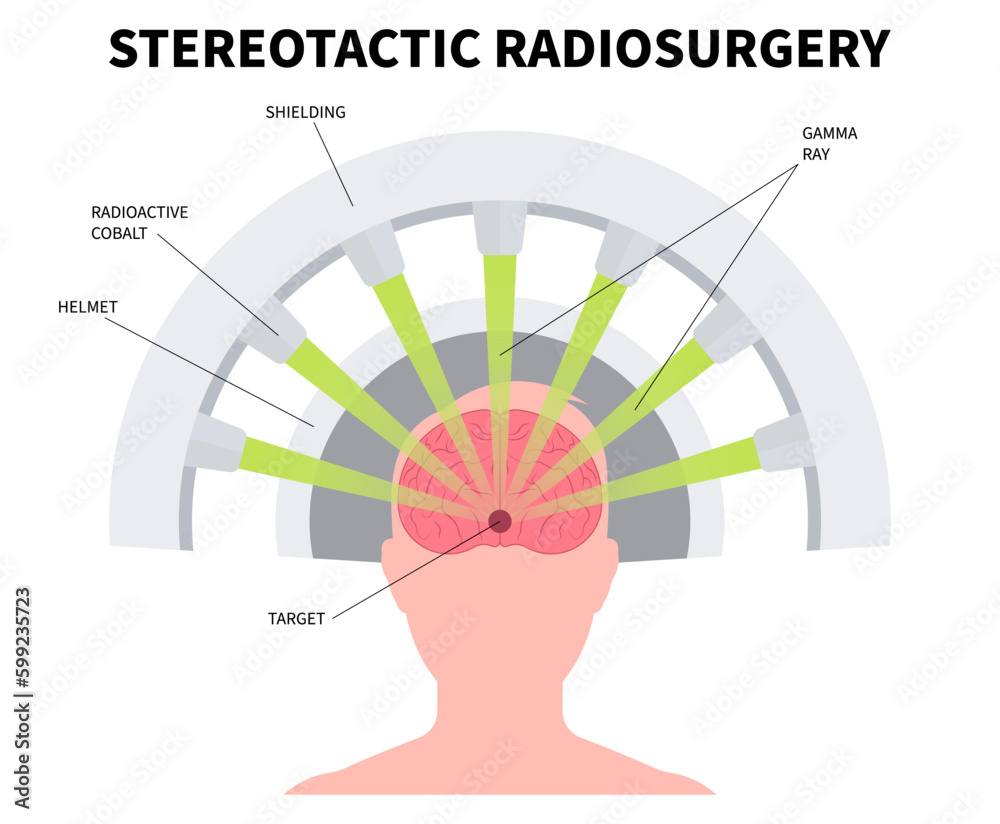 Central nervous system disease Radiosurgery X-ray and MRI imaging scan ...