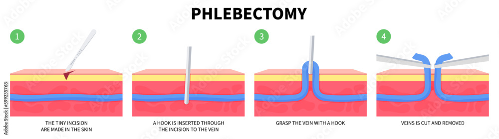 Phlebectomy Medical Anatomy of Vascular Artery Disease Varicose Vein ...