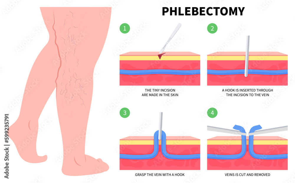 Limb Injury Phlebectomy Medical Anatomy of Vascular Artery Disease ...