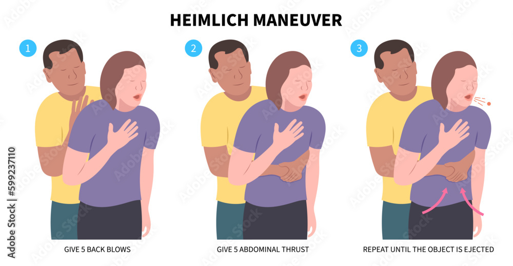 Choking first aid baby food CPR child step lodges blocking victim adult help abdomen kids ...