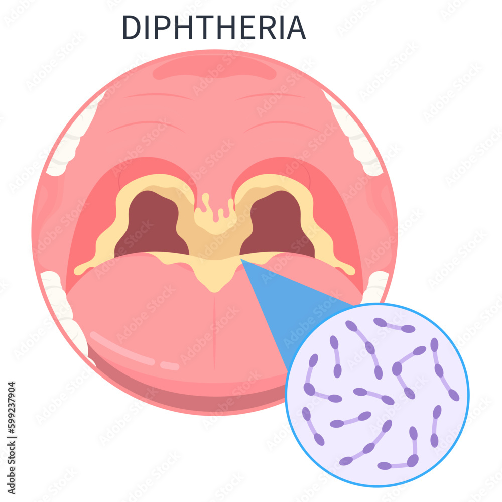 Diphtheria vaccine of group A with the tetanus croup strep throat bacterial Stock Vector | Adobe ...