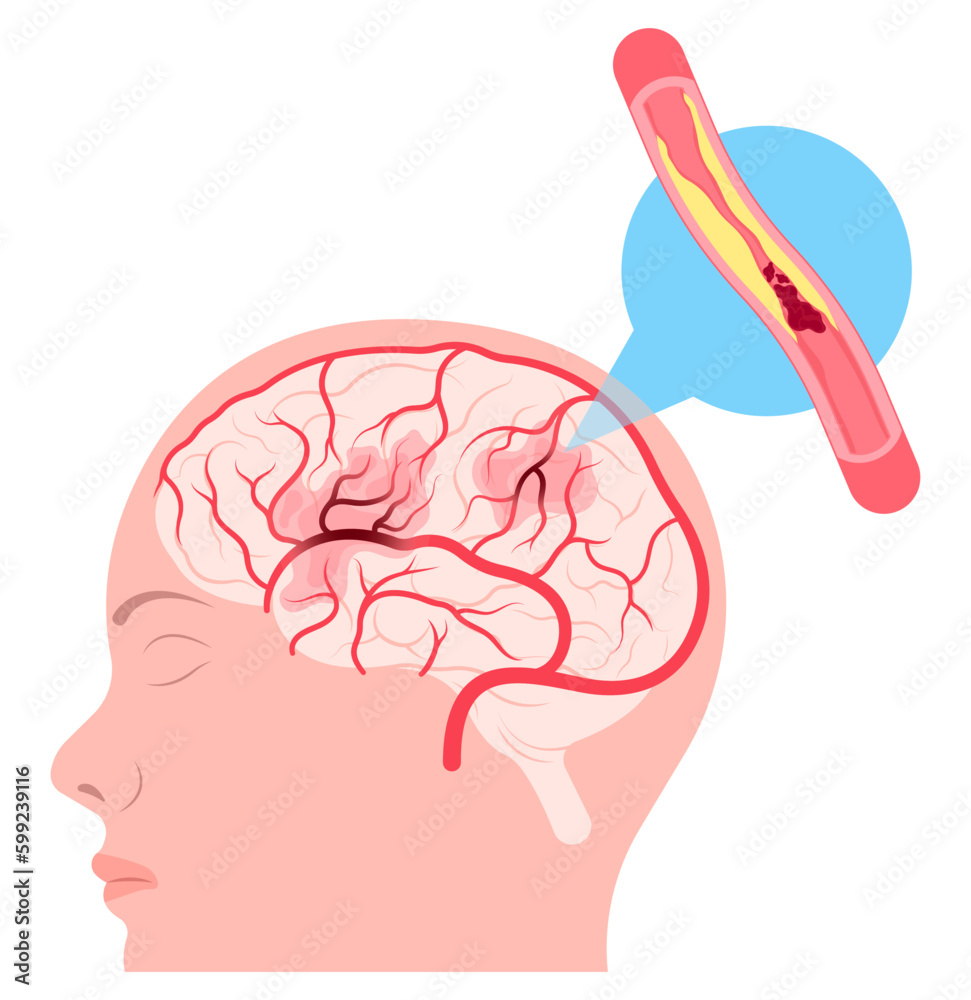 Brain frontal lobe damage signs symptom of Stroke vascular dementia ...
