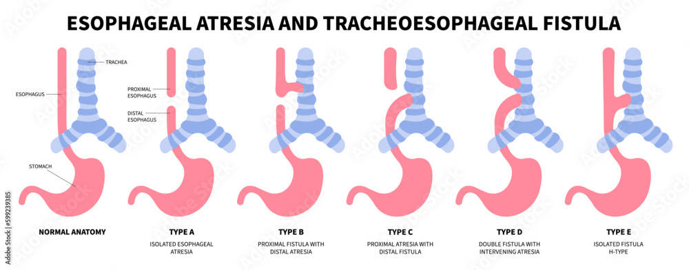 esophageal atresia tracheoesophageal fistula of baby and newborn infant ...