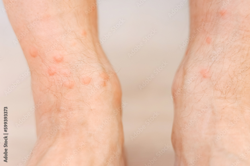 Close up allergic rash dermatitis eczema on man foot. Leg with red rash ...