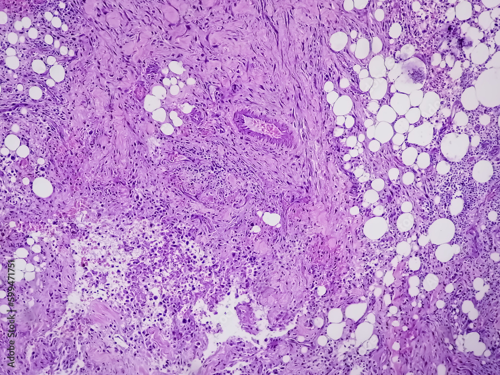 Photomicrograph of breast abscess, Granulomatous mastitis, show dense ...