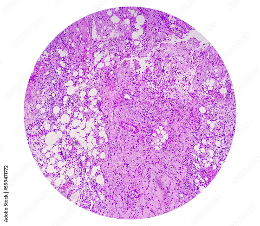 Photomicrograph of breast abscess, Granulomatous mastitis, show dense ...