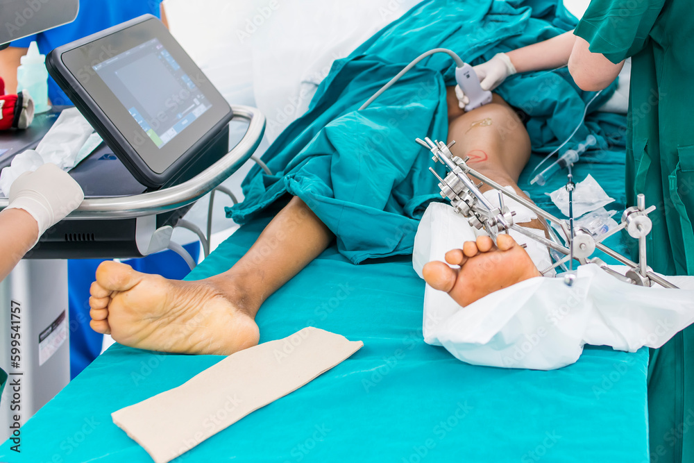 External fixator device in trauma or fracture patient in orthopedic ...