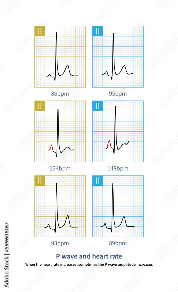 When the heart rate increases, sometimes the P wave amplitude increases ...