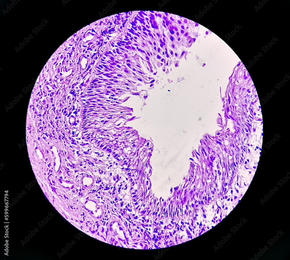 Histology of urachal cyst. Photomicrograph of histological stained ...