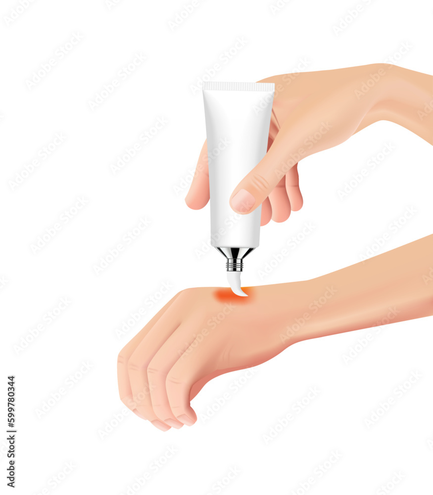 Skin burn injury treatment. First aid for burn wound vector ...