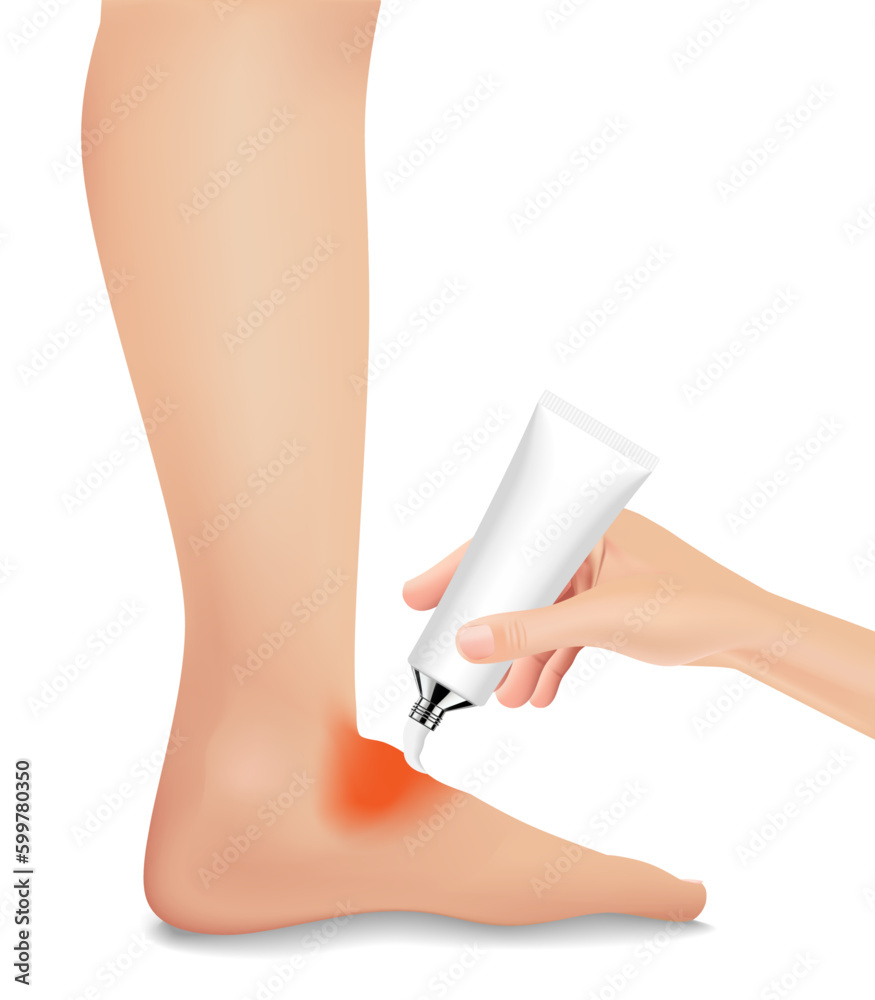 The injured foot is red and swollen like a realristic, treatment with ...