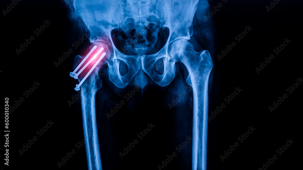 Blue tone radiograph on black background space in hospital.Doctor used ...