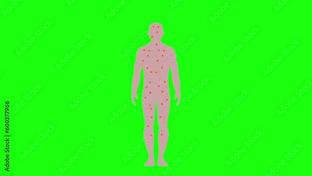 Allergic reactions in Human body Animation, viruses, and bacteria ...