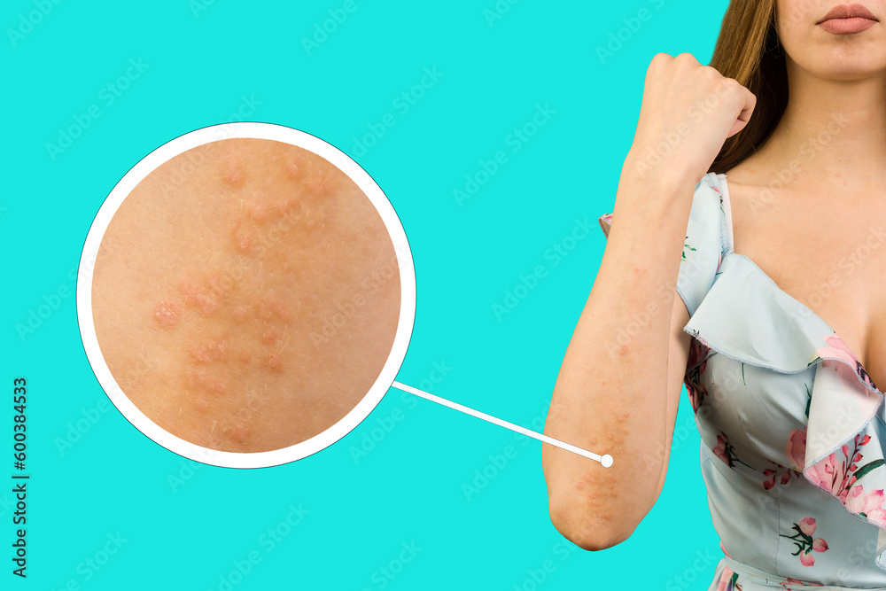 Macro detailed circles magnification psoriasis arm skin with different ...