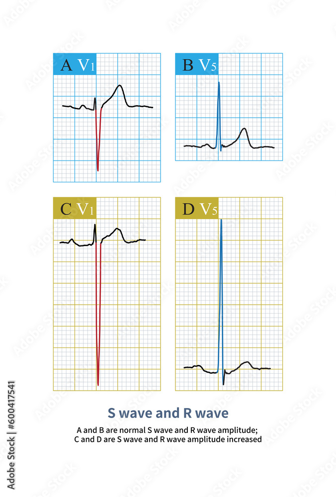 A and B are the normal S wave and R wave amplitude; C and D are the S ...