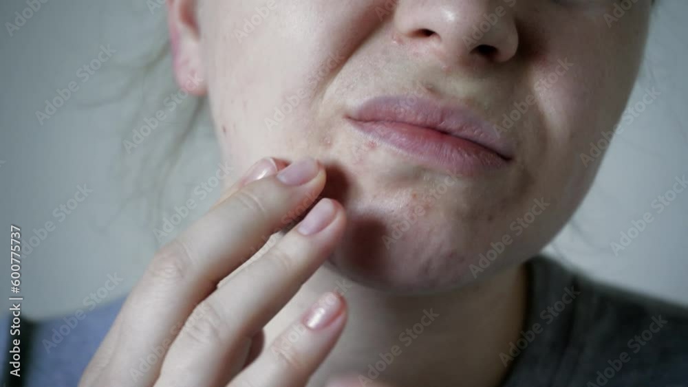 Close up of skin problems, unhealthy skin with acne and pimples. Porous ...