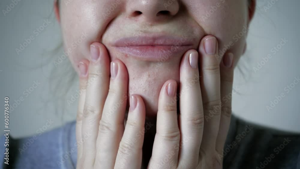 Close up of skin problems, unhealthy skin with acne and pimples. Porous ...