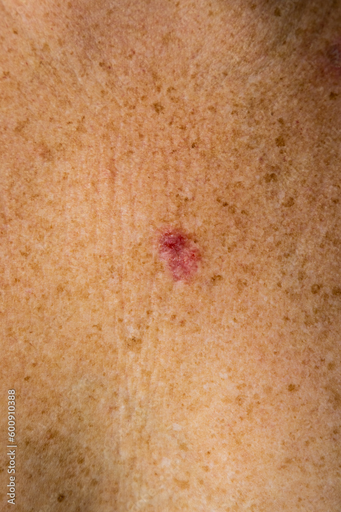 Foto de Macro view of superficial basal cell carcinoma showing red ...