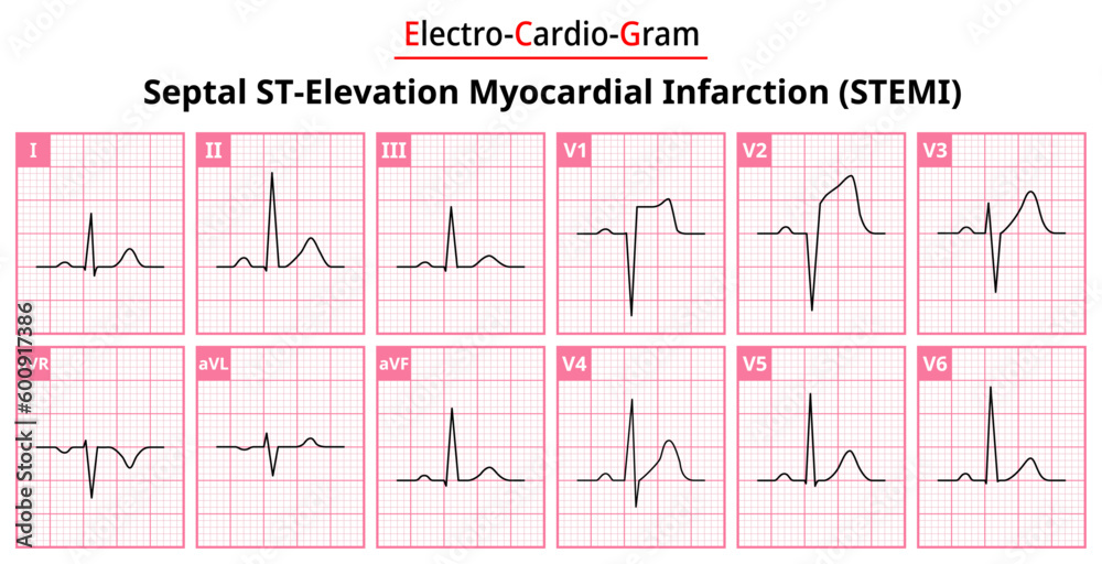 Septal STEMI (ST-Elevation Myocardial Infarction) - The Differences in ...