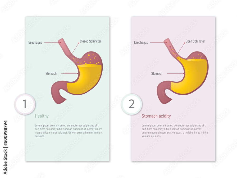 Infographic of the stomach when it is healthy and when there is stomach ...