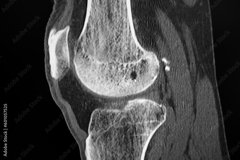 CT Aufnahme eines linken Kniegelenks mit gut erkennbarer Knochenzyste ...