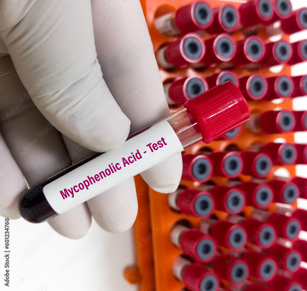 Blood sample for Mycophenolic Acid (MPA) test, to monitor therapeutic ...
