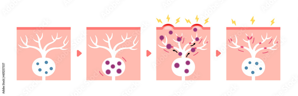 Mechanism of shingles ( herpes zoster ) vector illustration (including ...