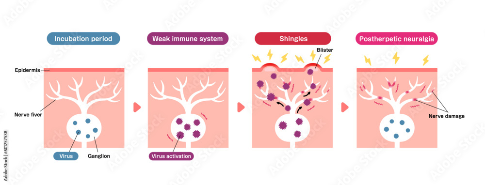 Mechanism of shingles ( herpes zoster ) vector illustration Stock ...