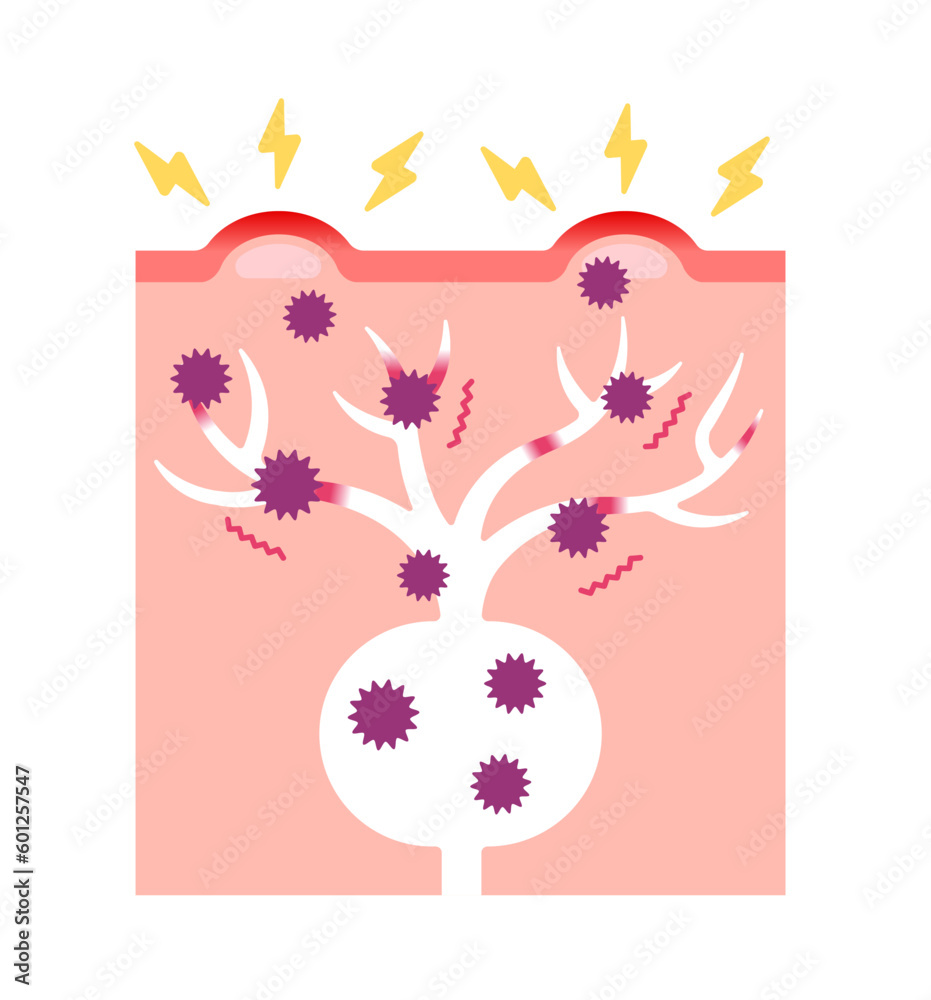 Mechanism of shingles ( herpes zoster ) vector illustration Stock ...
