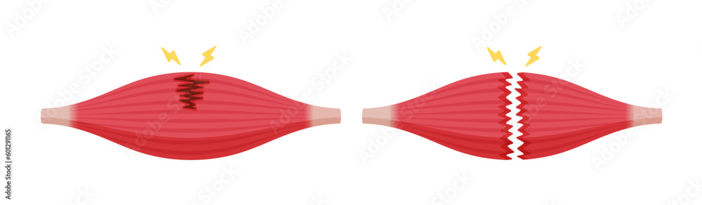 Muscle rupture vector illustration (partial and complete tears ) Stock ...