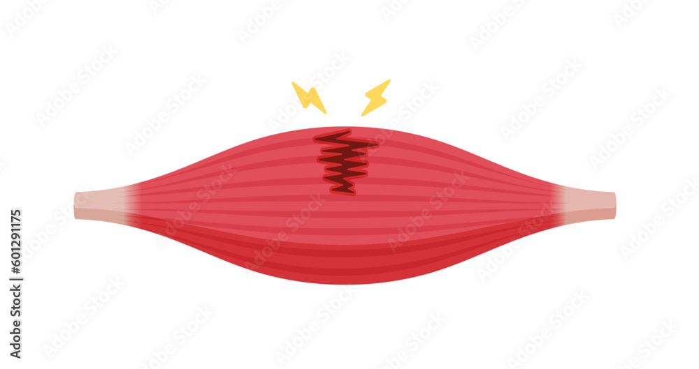 Muscle rupture vector illustration (partial tear ) Stock Vector | Adobe ...