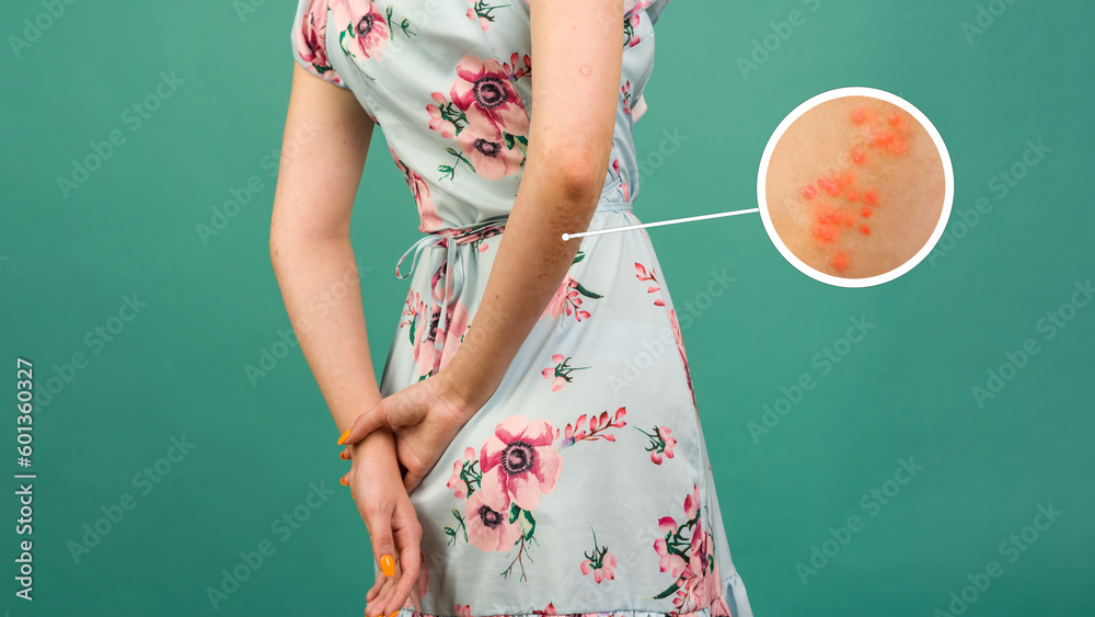 Macro detailed circles magnification psoriasis arm skin with different ...