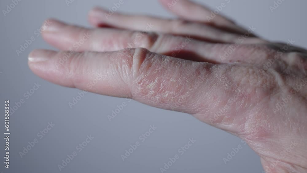 dermatology dry skin eczema disease psoriasis itchy epidermis palm hand ...