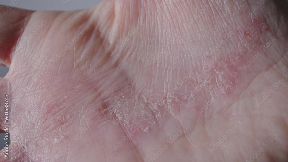 dermatology dry skin eczema disease psoriasis itchy epidermis palm hand ...
