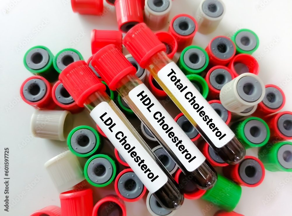 Blood samples isolated for Total Cholesterol testing, HDL Cholesterol ...