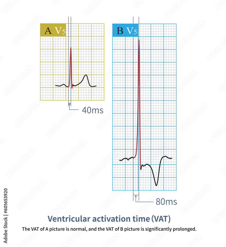 The left ventricular wall activation time is the time interval measured ...