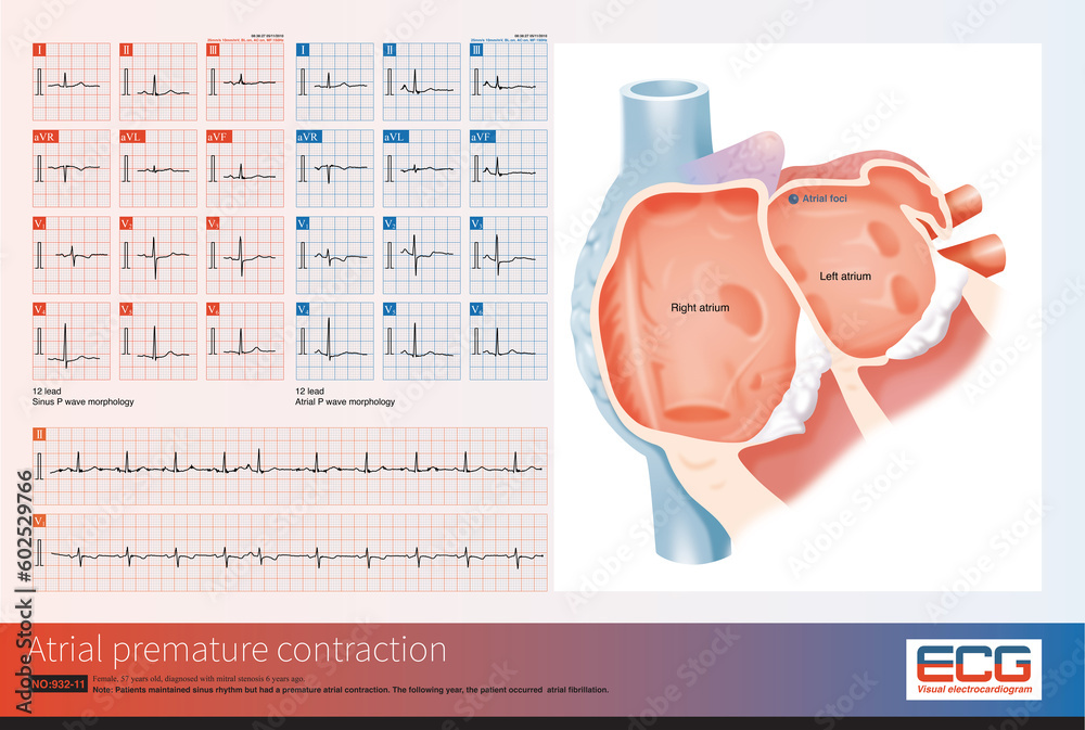 Female, 57 years old, diagnosed with mitral stenosis 6 years ago. This ...