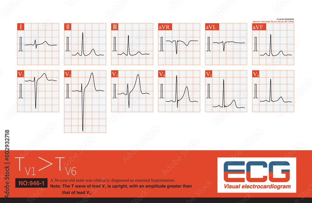The amplitude of T wave in lead V1 is most commonly seen in ...