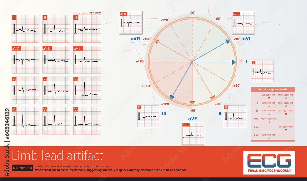A 55-year-old woman with a clinical diagnosis of mitral stenosis ...