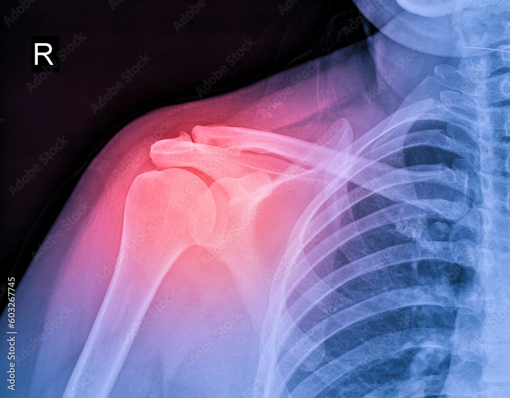 X-ray image of shoulder pain, shoulder ligament tendinitis, shoulder ...