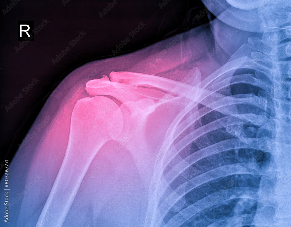 X-ray image of shoulder pain, shoulder ligament tendinitis, shoulder ...