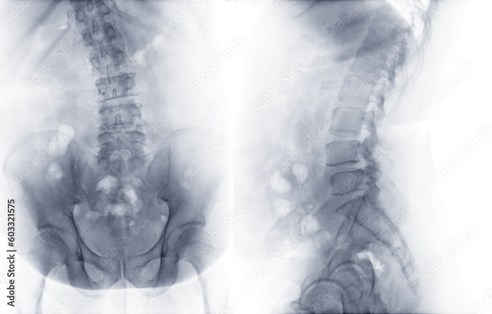 X-ray image of lumbar Spine or L-s spine AP and lateral view for ...