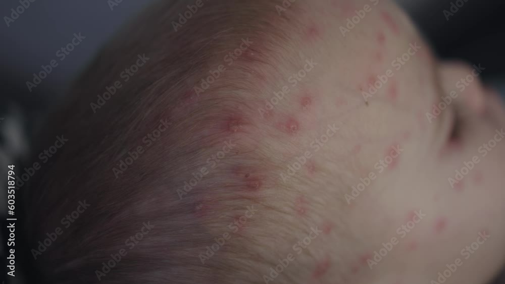 sick baby toddler child suffering from chickenpox symptoms lying sofa fever pimples blister face ...