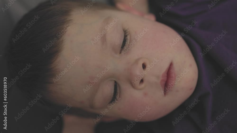 sick baby toddler child suffering from chickenpox symptoms lying sofa fever pimples blister face ...