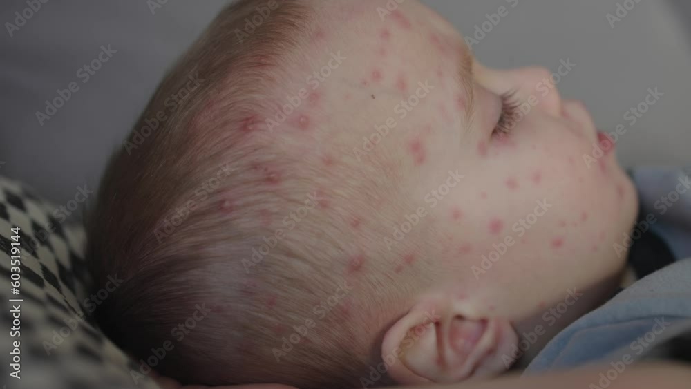 sick baby toddler child suffering from chickenpox symptoms lying sofa fever pimples blister face ...