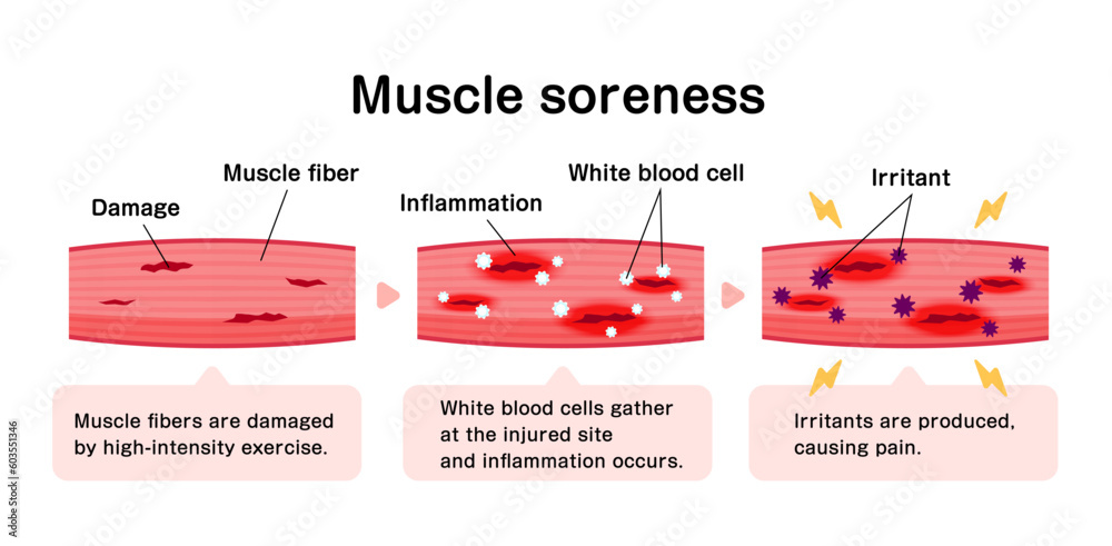 Mechanism of muscle soreness vector illustration Stock Vector | Adobe Stock