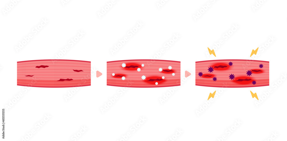 Mechanism of muscle soreness vector illustration (no text ) Stock ...